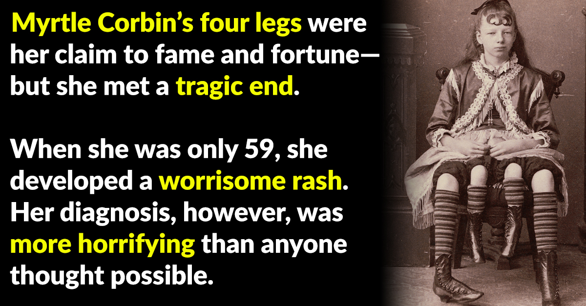 Facts About Myrtle Corbin, The Four-Legged Woman